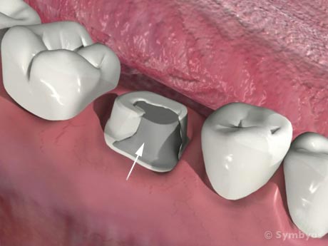 Core Build-Up Materials – Dental Solutions